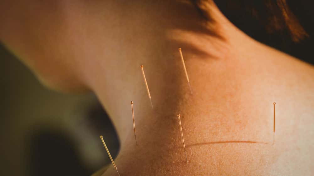 Chronic Neck and Shoulder Pain Medication with Acupuncture